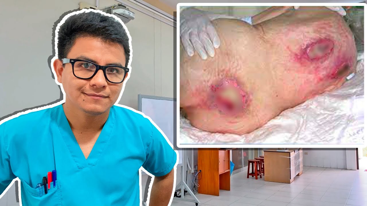 ¿Qué es una escara en la piel? síntomas, tratamiento y prevención ...