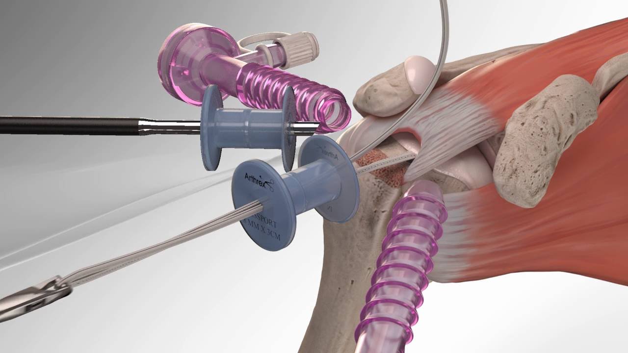 Rotator cuff surgery: the secret recipe for becoming a human ceiling ...