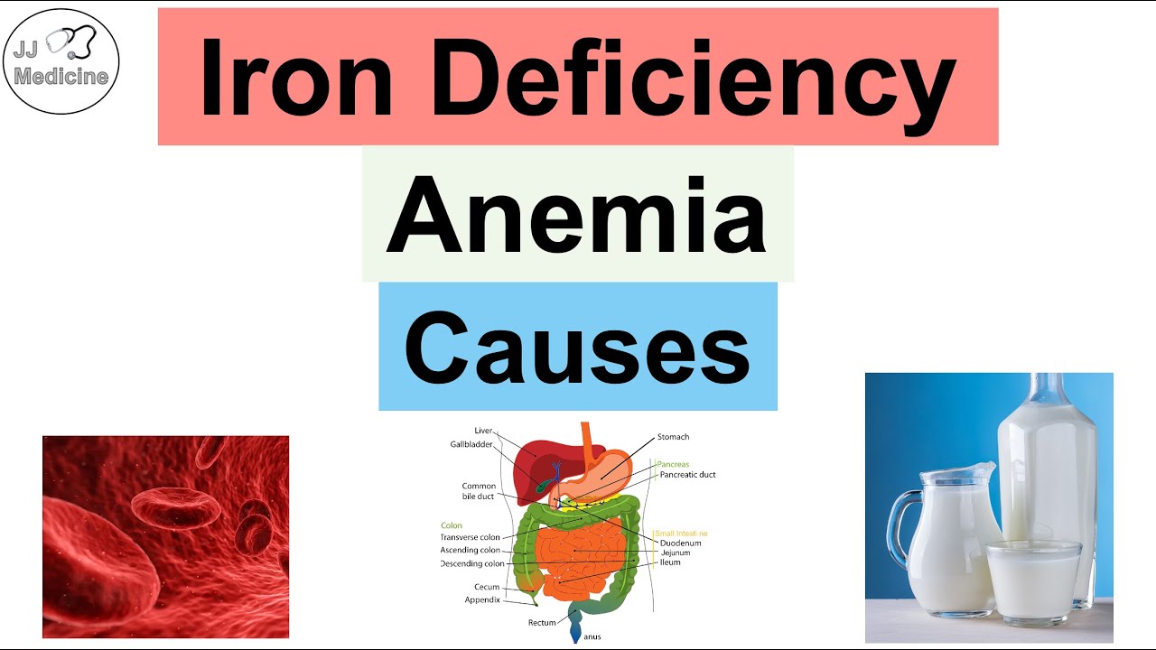 What causes iron deficiency? the spoon conspiracy, kale’s dark secret ...