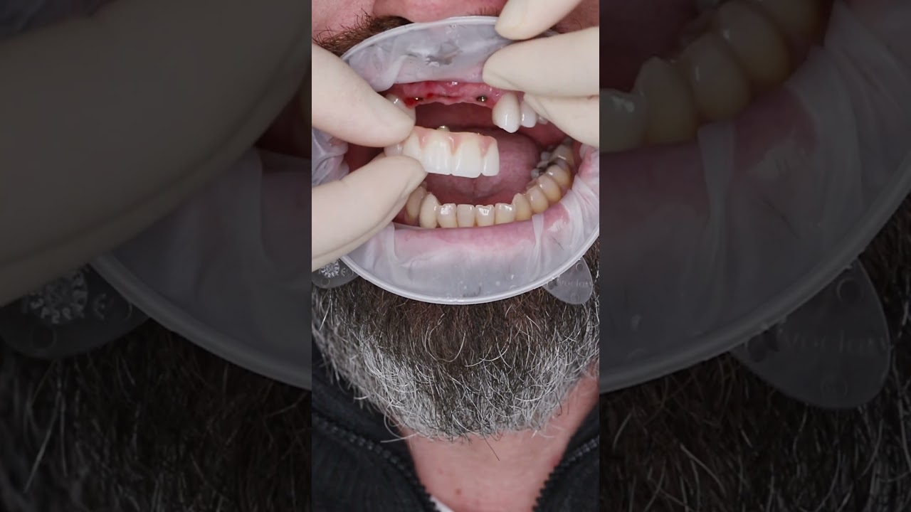 Permanent Dental Implants: The Ultimate Guide to a Lasting Smile ...